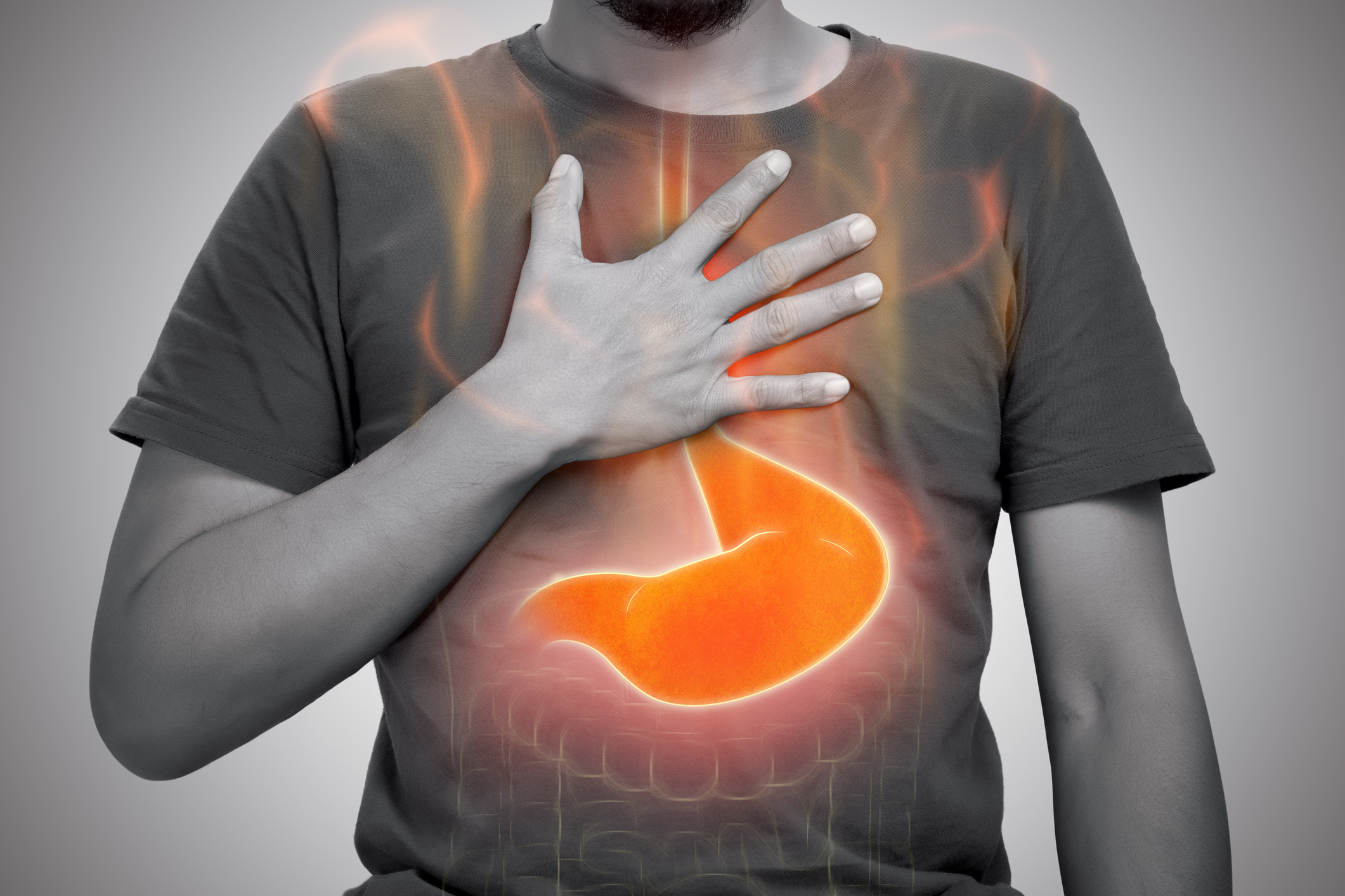 Gastro-oesophageal reflux disease (GORD) - Med iLearning